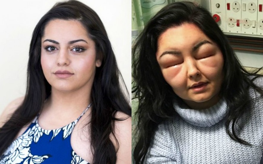 MidiaNews | Adolescente sofre com alergia a tinta de cabelo: "Eu me ...