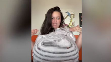 MidiaNews | Mulher tem doença dos seios gigantes e conta que tem medo ...