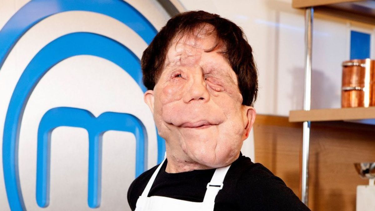 MidiaNews | Conheça a doença rara que deixou ator com o rosto desfigurado